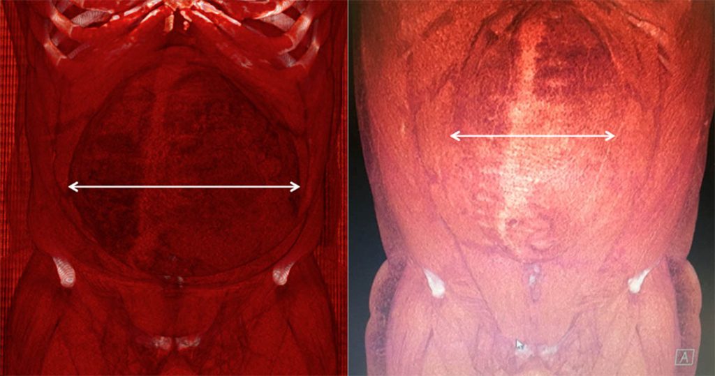 Complex Hernia and Prehabilitation of the Abdominal Wal